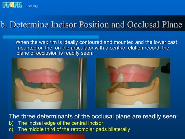 9.record base and wax rim fabrication | PPT