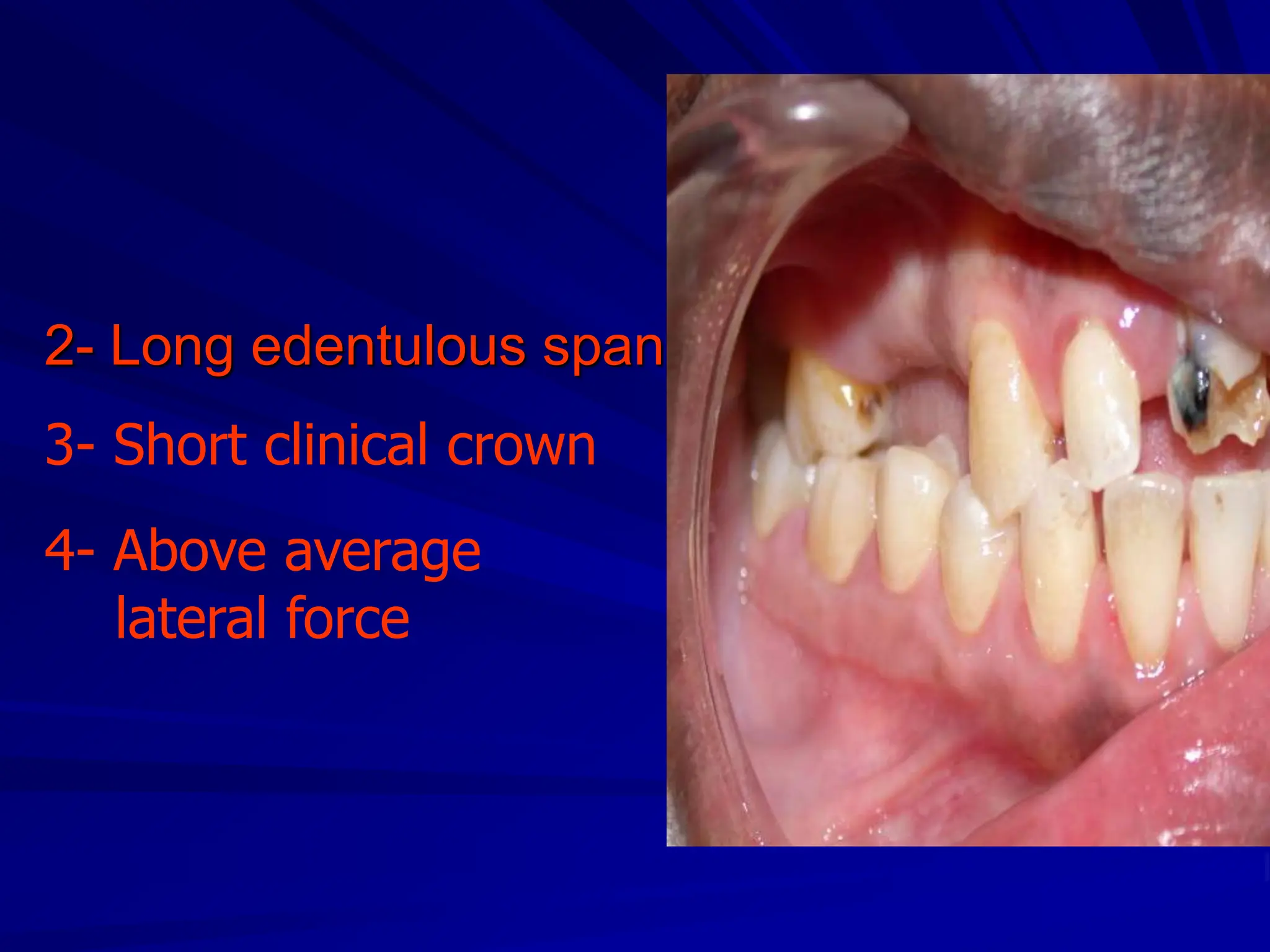 9_RESIN-BONDED_FIXED_PARTIAL_DENTURE.ppt