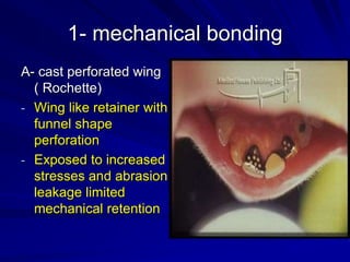 9_RESIN-BONDED_FIXED_PARTIAL_DENTURE.ppt