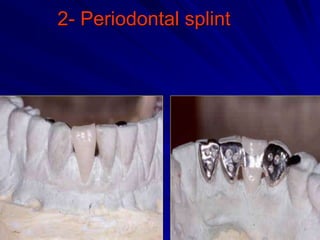 9_RESIN-BONDED_FIXED_PARTIAL_DENTURE.ppt