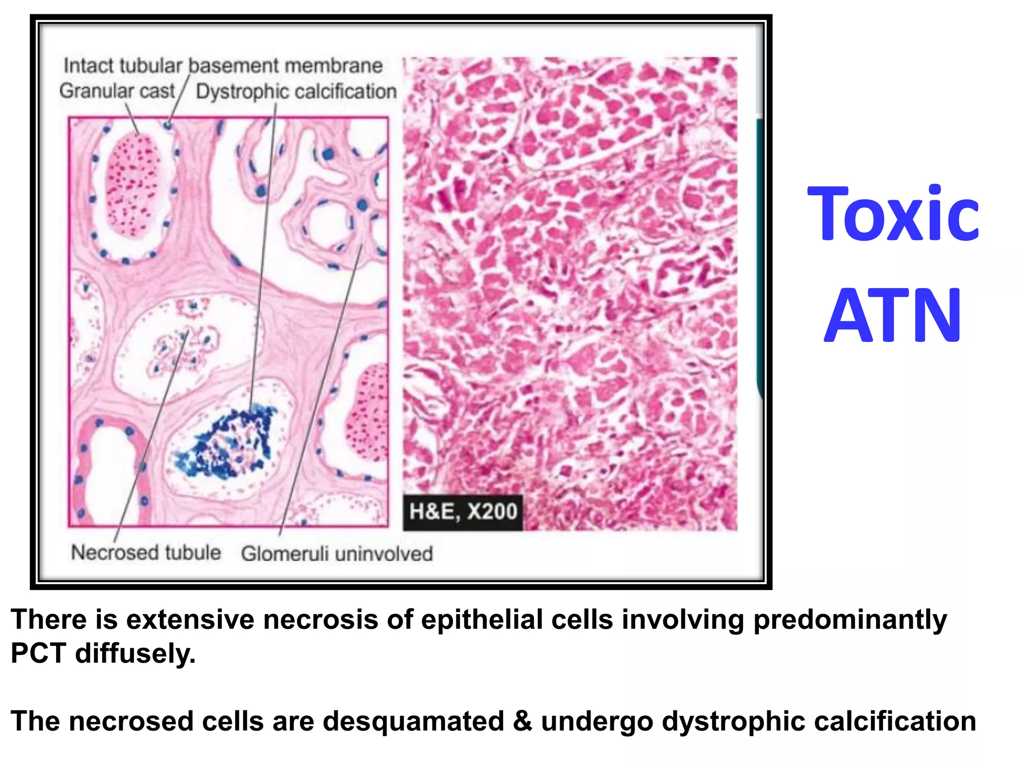 THE KIDNEY: TUBULAR & TUBULOINTERSTITIAL DISEASES | PPTX