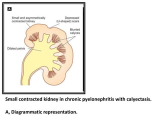 THE KIDNEY: TUBULAR & TUBULOINTERSTITIAL DISEASES | PPTX
