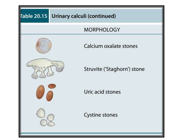 The Kidney: OBSTRUCTIVE UROPATHY | PPTX | Digestive Disorders ...