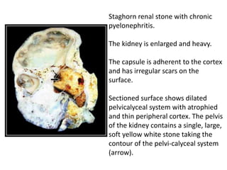 The Kidney: OBSTRUCTIVE UROPATHY | PPTX
