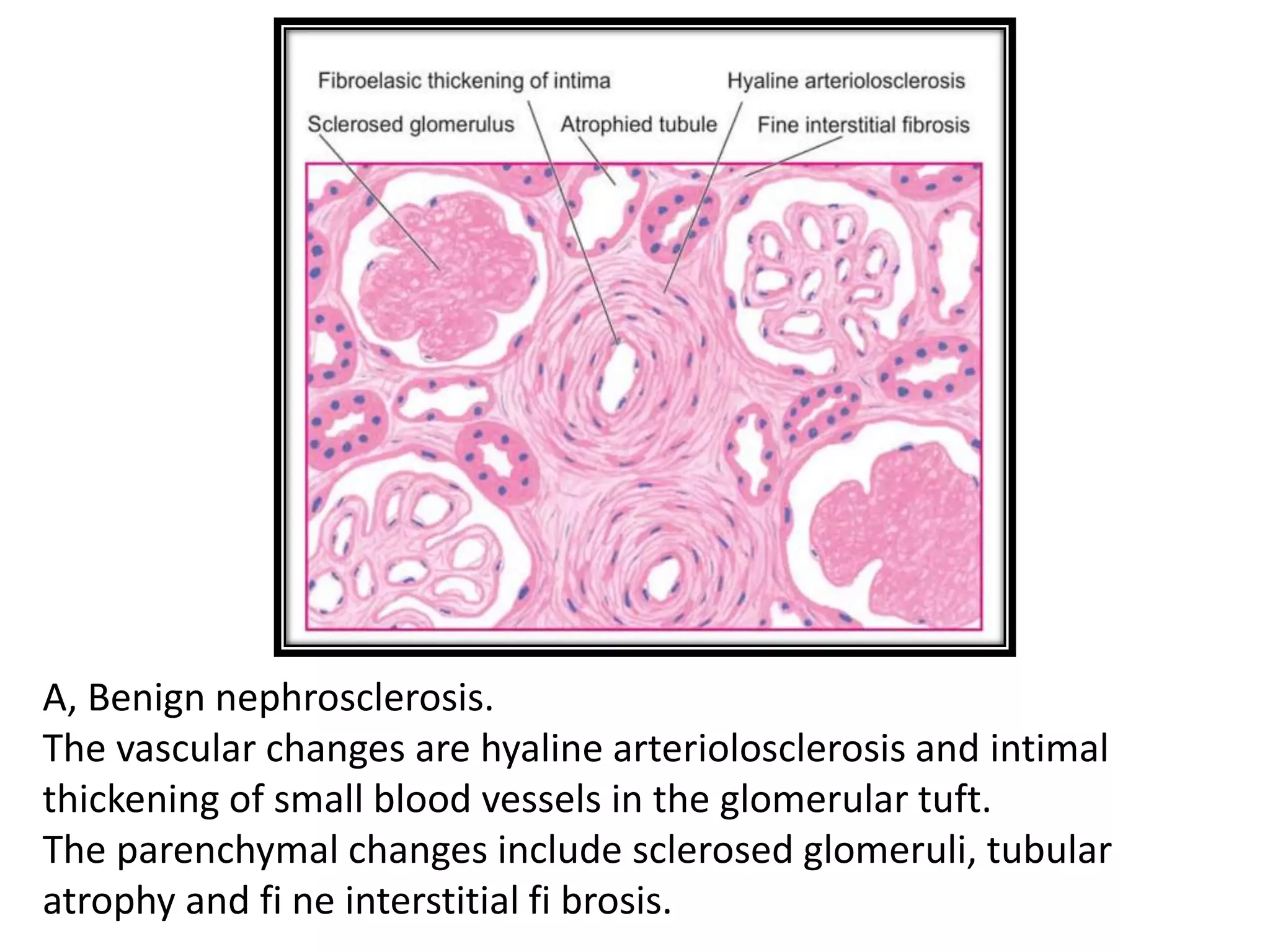 The KIDNEY: RENAL VASCULAR DISEASES | PPTX