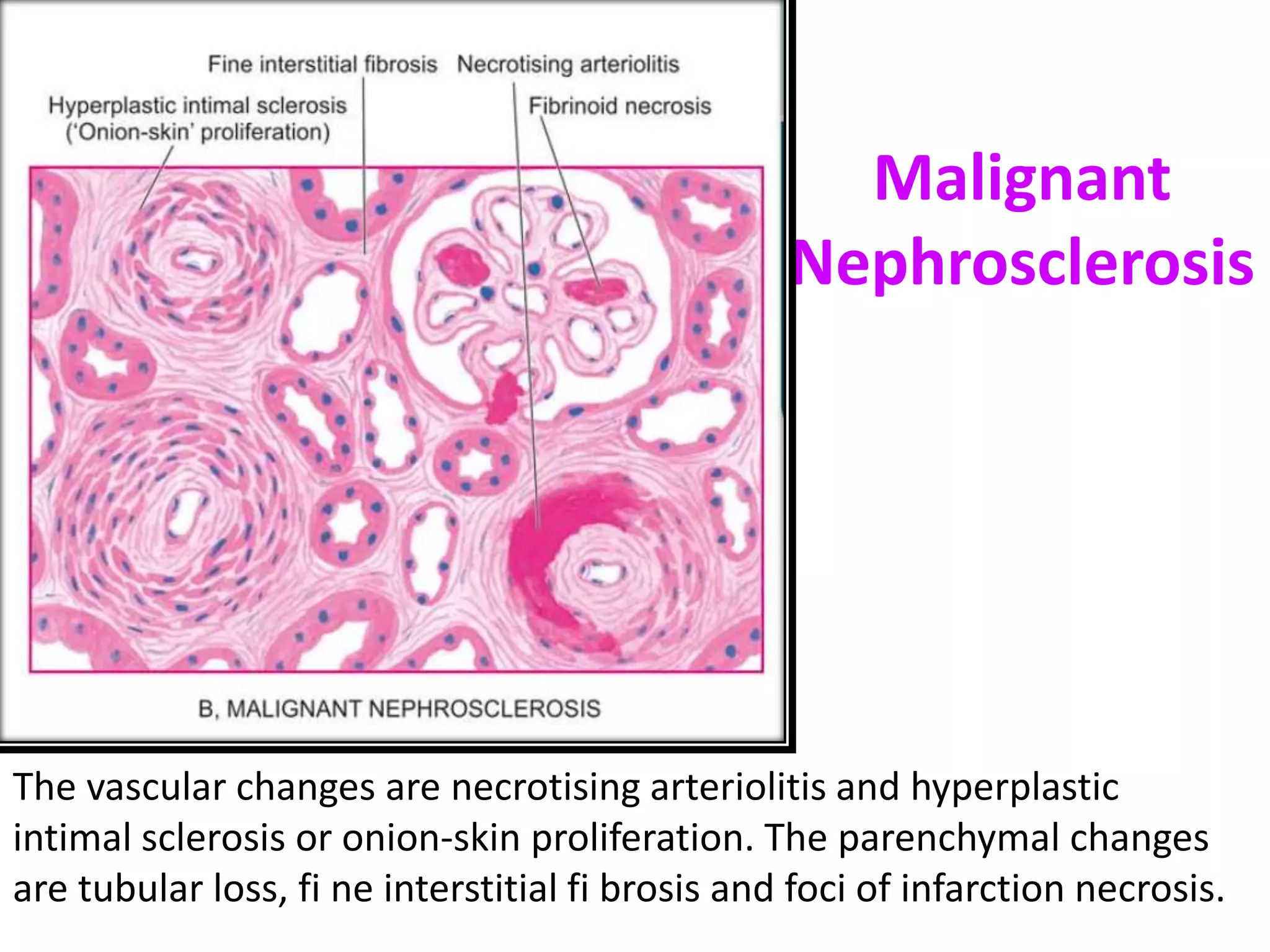 The KIDNEY: RENAL VASCULAR DISEASES | PPTX