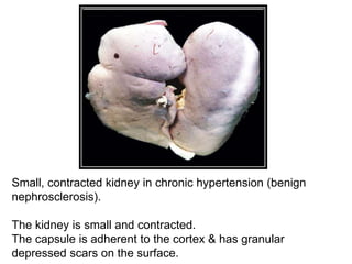 The KIDNEY: RENAL VASCULAR DISEASES | PPTX