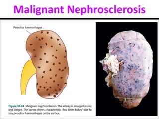 The KIDNEY: RENAL VASCULAR DISEASES | PPTX