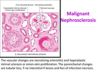 The KIDNEY: RENAL VASCULAR DISEASES | PPTX