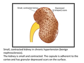 The KIDNEY: RENAL VASCULAR DISEASES | PPTX