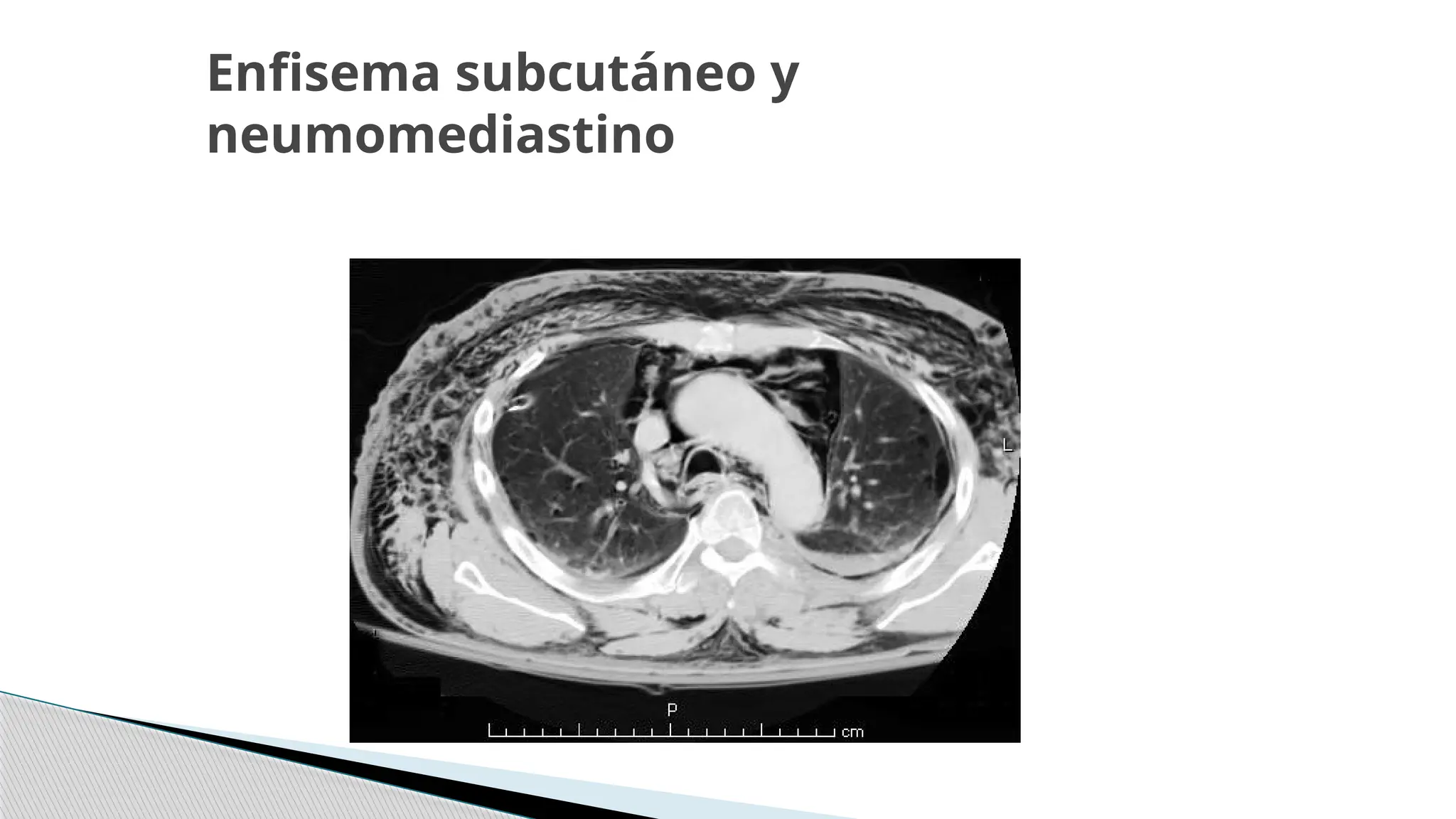 9 - Trauma de Tórax, ABCD y manejo del trauma.pptx