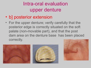 9-try in stage in complete denture..ppt