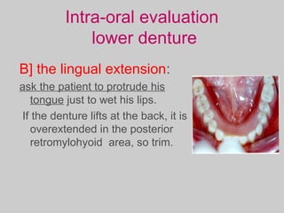 9-try in stage in complete denture..ppt