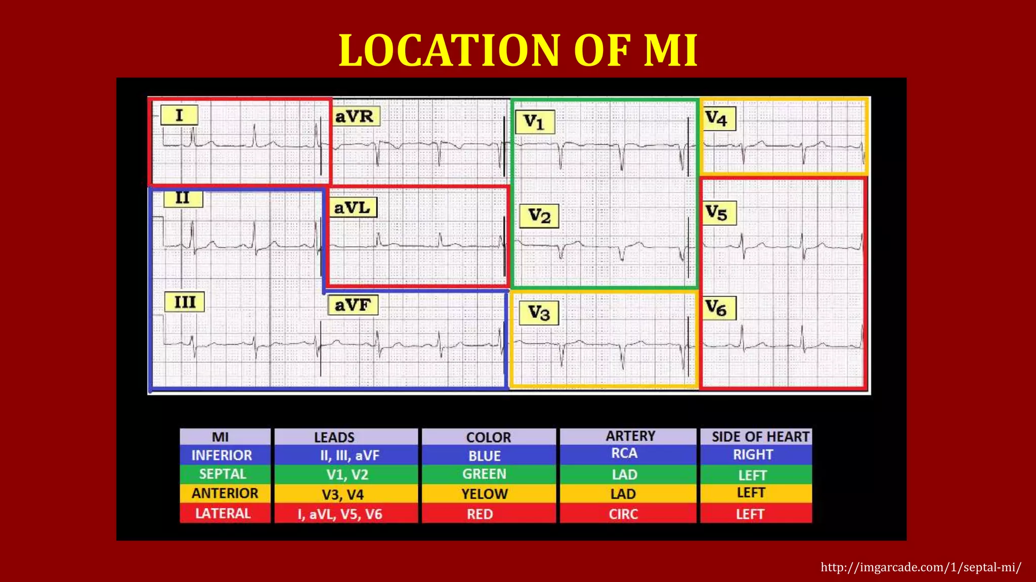 ST-Elevation Myocardial Infarction | PPTX