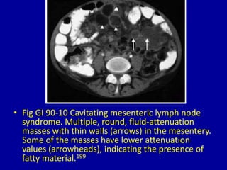 90 fatty lesions in the abdomen and pelvis | PPTX