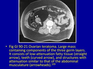 90 fatty lesions in the abdomen and pelvis | PPTX