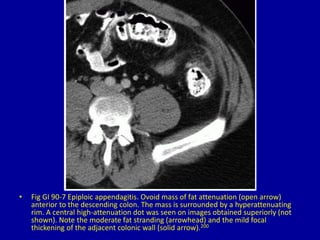 90 fatty lesions in the abdomen and pelvis | PPT