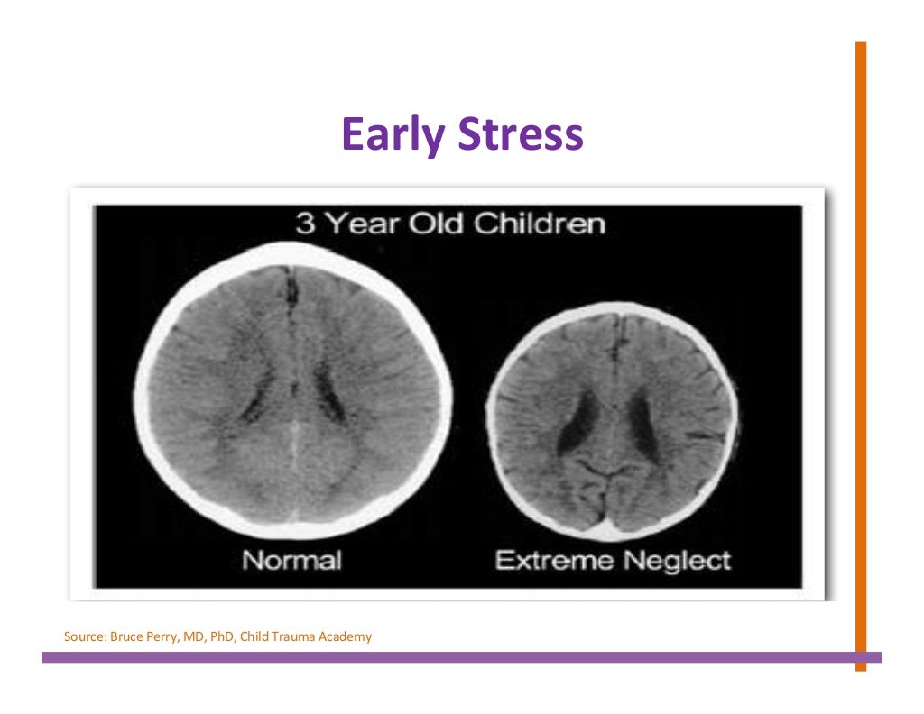 Childhood trauma's impact on the developing brain