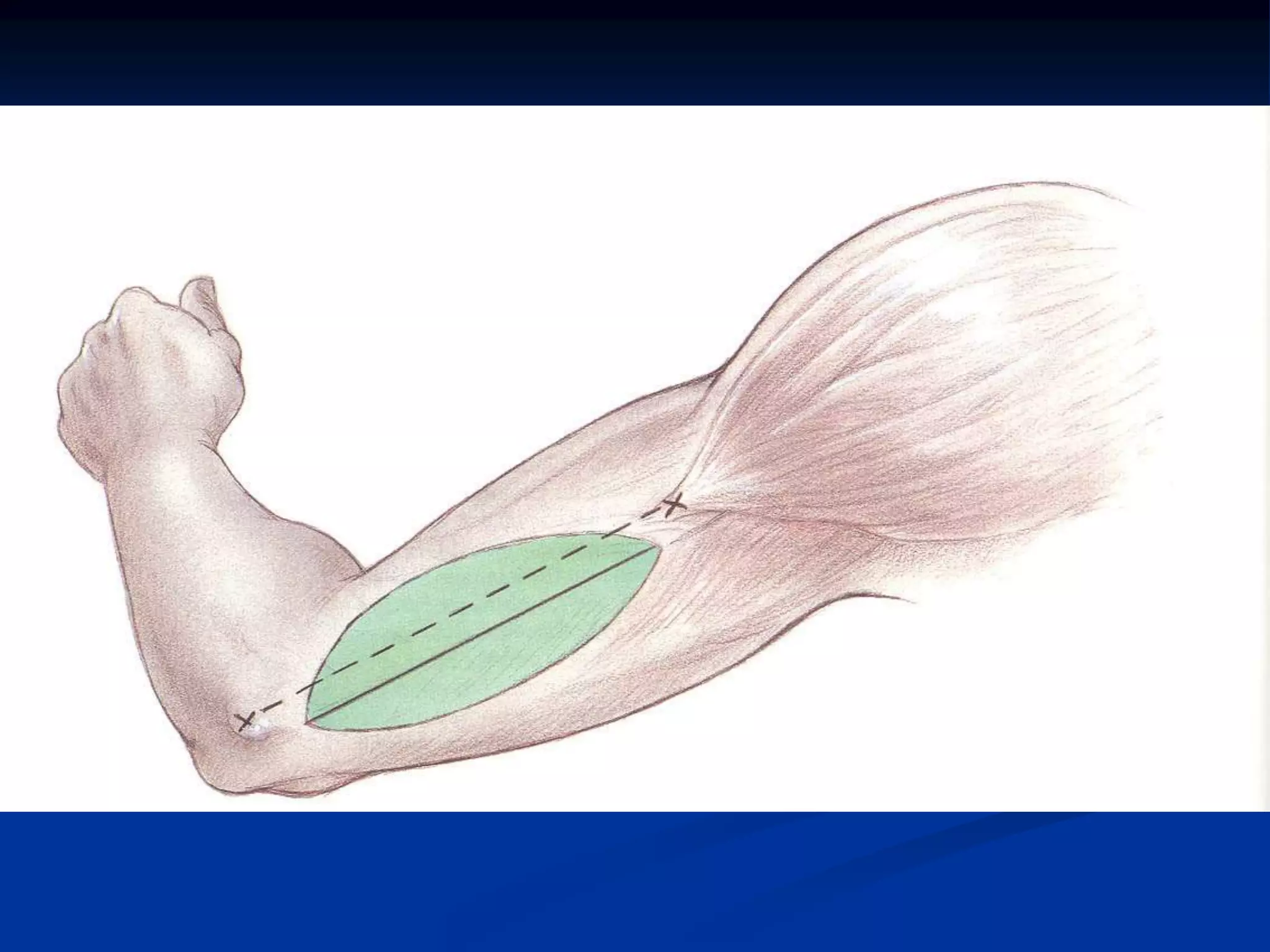 9162_free-flap-reconstruction-of-head-and-neck-defects.ppt