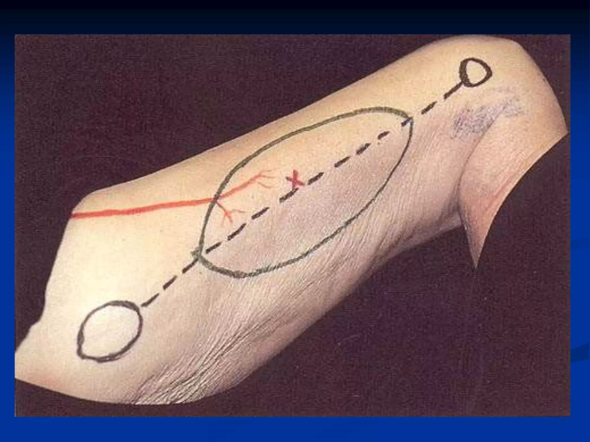 9162_free-flap-reconstruction-of-head-and-neck-defects.ppt