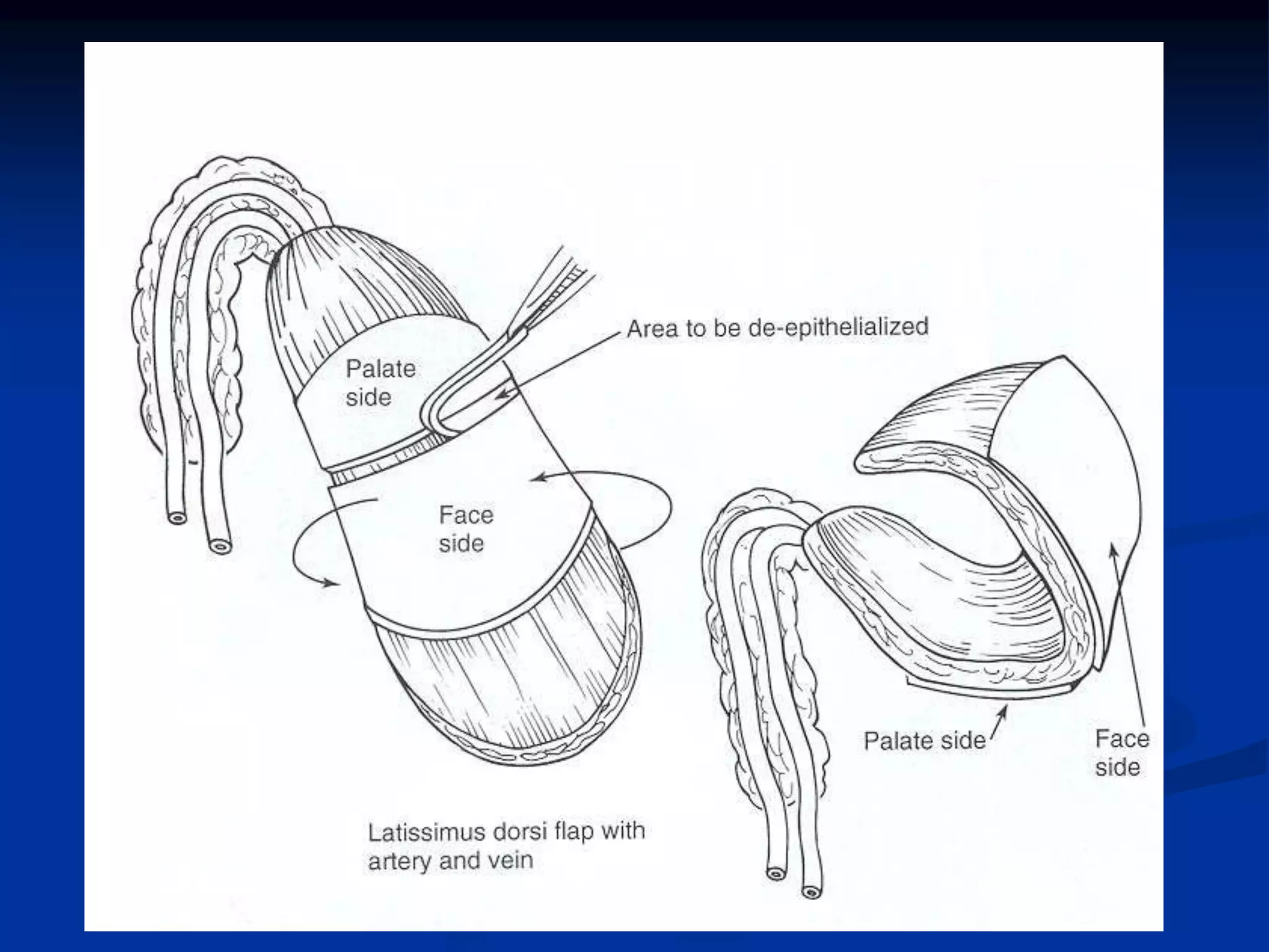 9162_free-flap-reconstruction-of-head-and-neck-defects.ppt