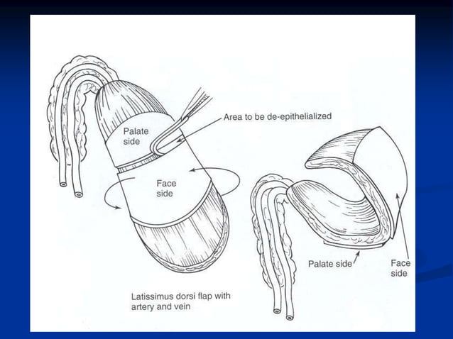 9162_free-flap-reconstruction-of-head-and-neck-defects.ppt