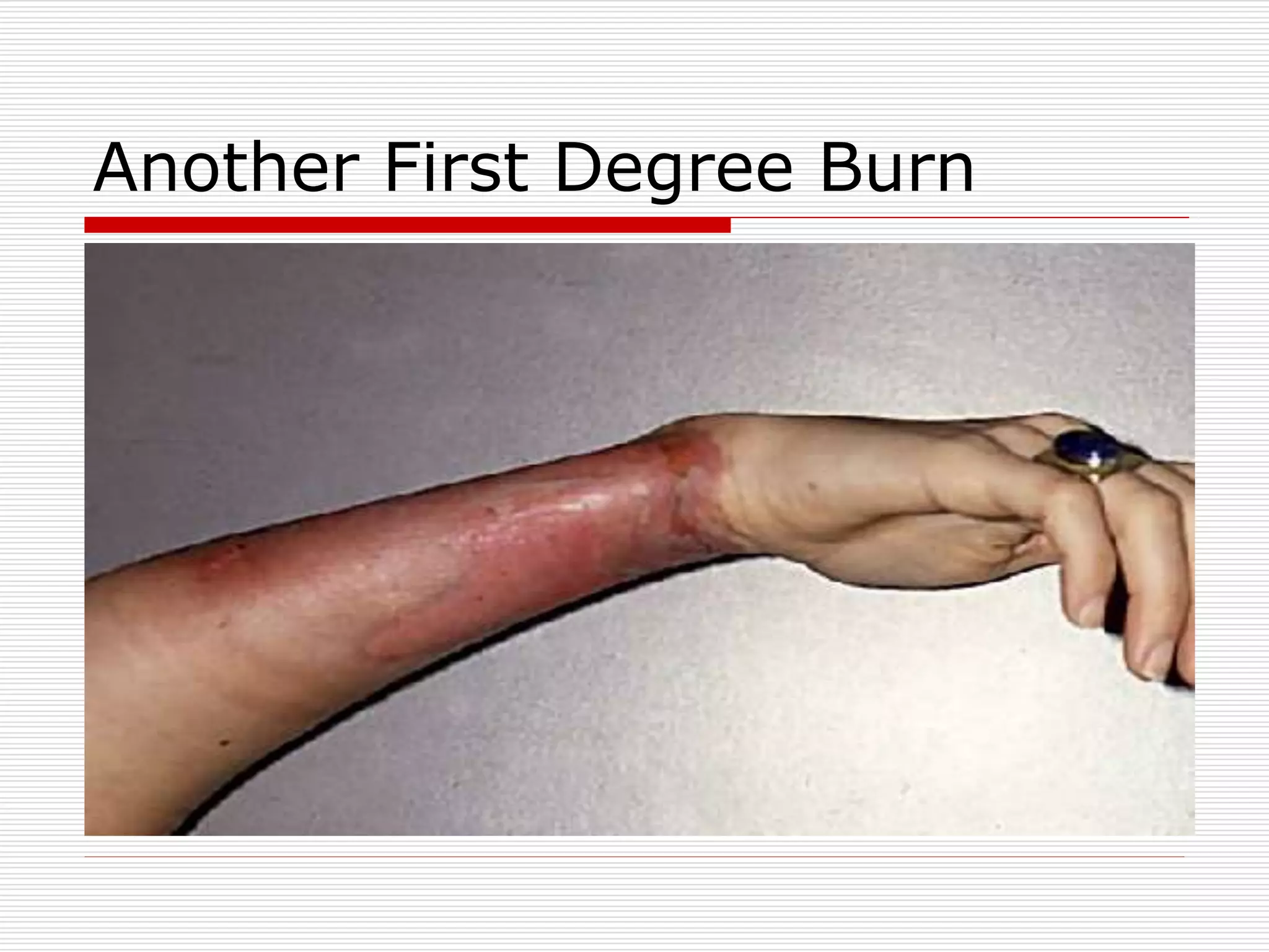 91971688-Care-of-the-Burn-Patient-Jaf.ppt