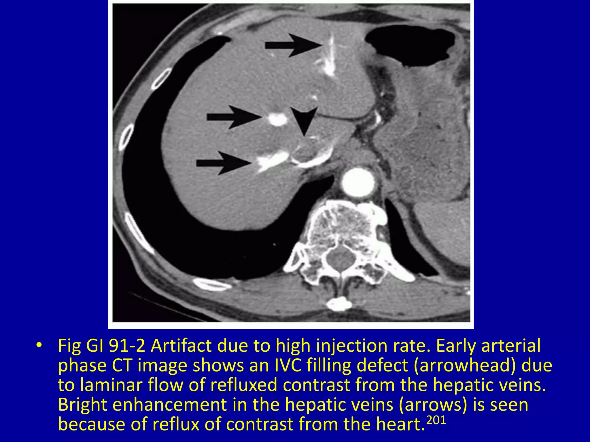 91 inferior vena cava (ivc) filling | PPTX