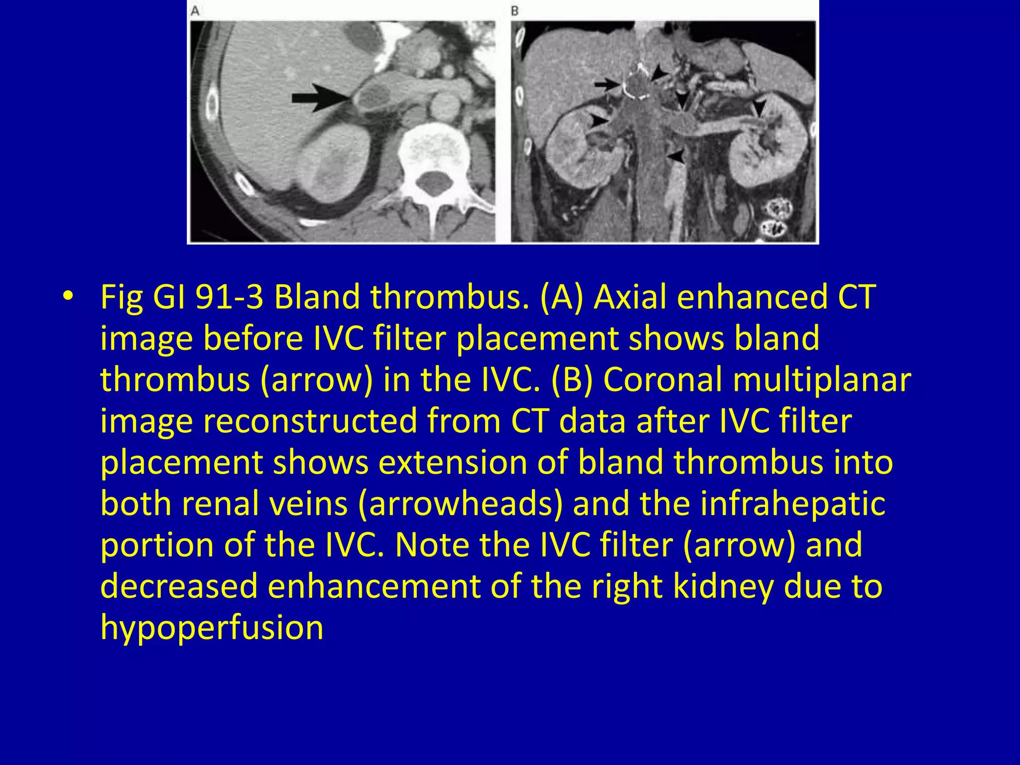 91 inferior vena cava (ivc) filling | PPTX