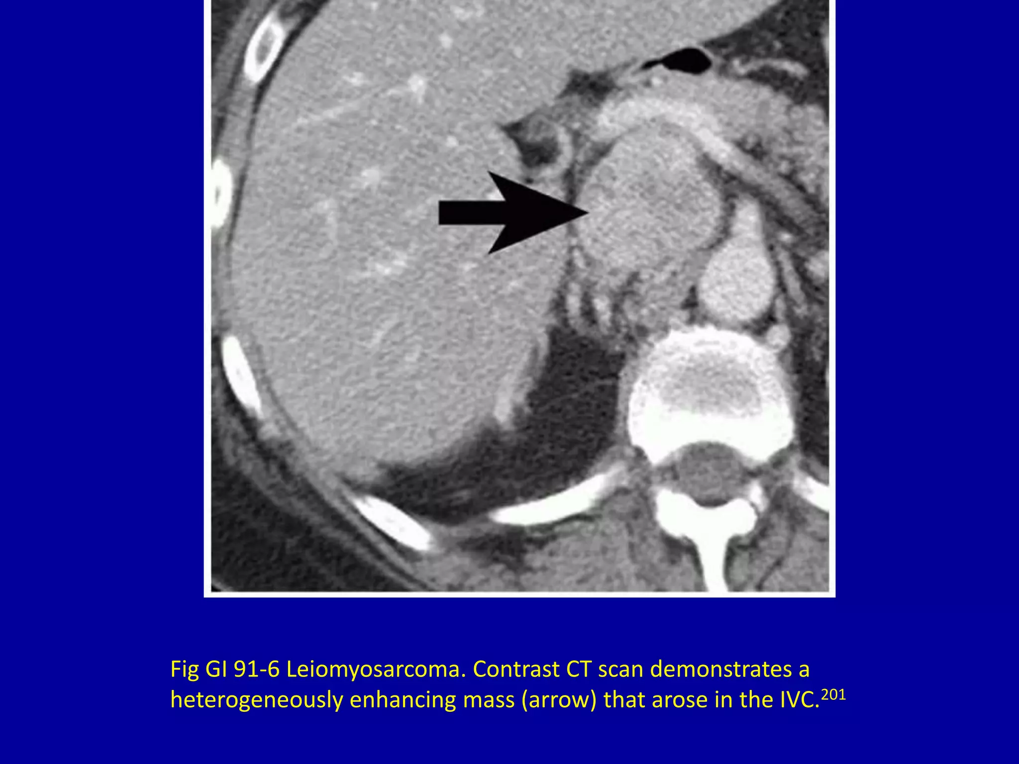 91 inferior vena cava (ivc) filling | PPTX