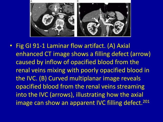 91 inferior vena cava (ivc) filling | PPTX