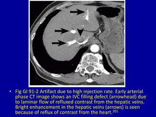 91 inferior vena cava (ivc) filling | PPTX