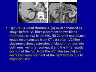 91 inferior vena cava (ivc) filling | PPTX