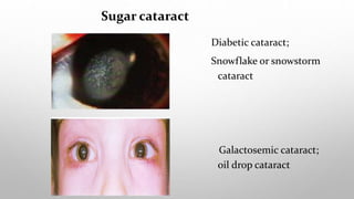 Physiology of lens and Cataractogenesis | PPTX