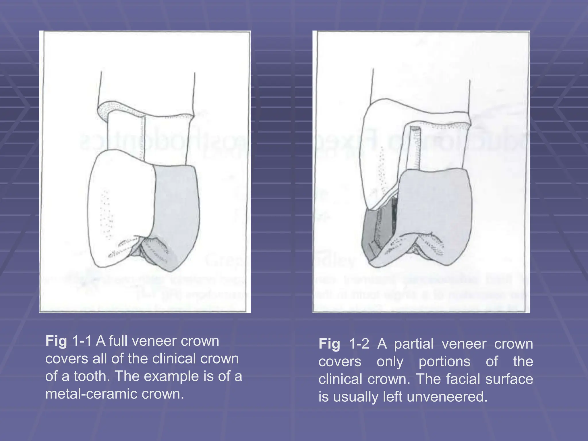 9202750.ppt pathological tooth wear. Attraction. Erosion | PPT