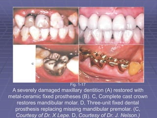 9202750.ppt pathological tooth wear. Attraction. Erosion | PPT