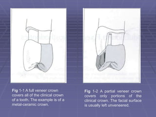 9202750.ppt pathological tooth wear. Attraction. Erosion | PPT