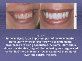 9202750.ppt pathological tooth wear. Attraction. Erosion | PPT