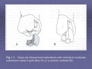 9202750.ppt pathological tooth wear. Attraction. Erosion | PPT