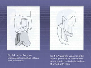 9202750.ppt pathological tooth wear. Attraction. Erosion | PPT