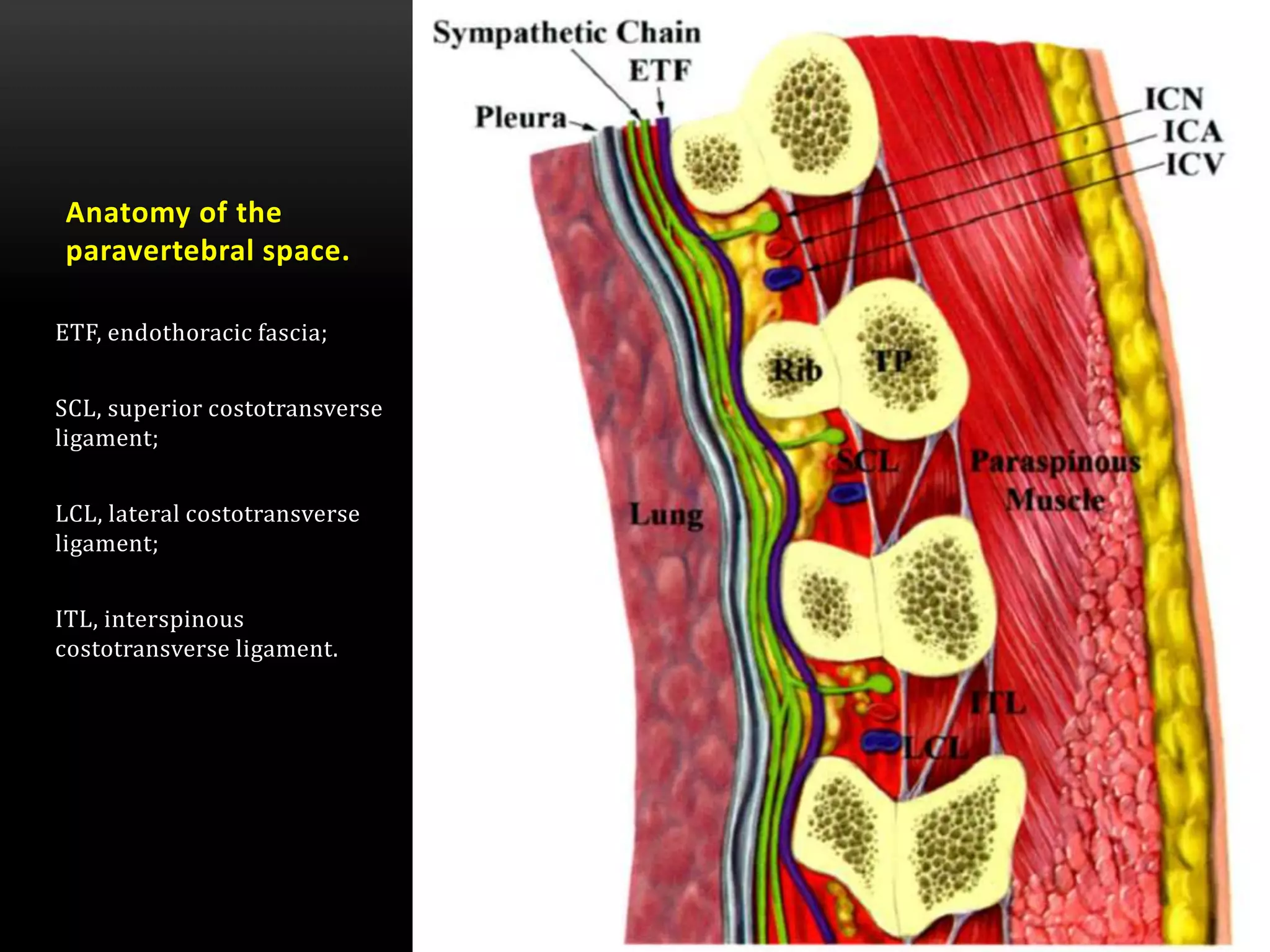 Ultrasound-Guided Thoracic Paravertebral Block | PPTX