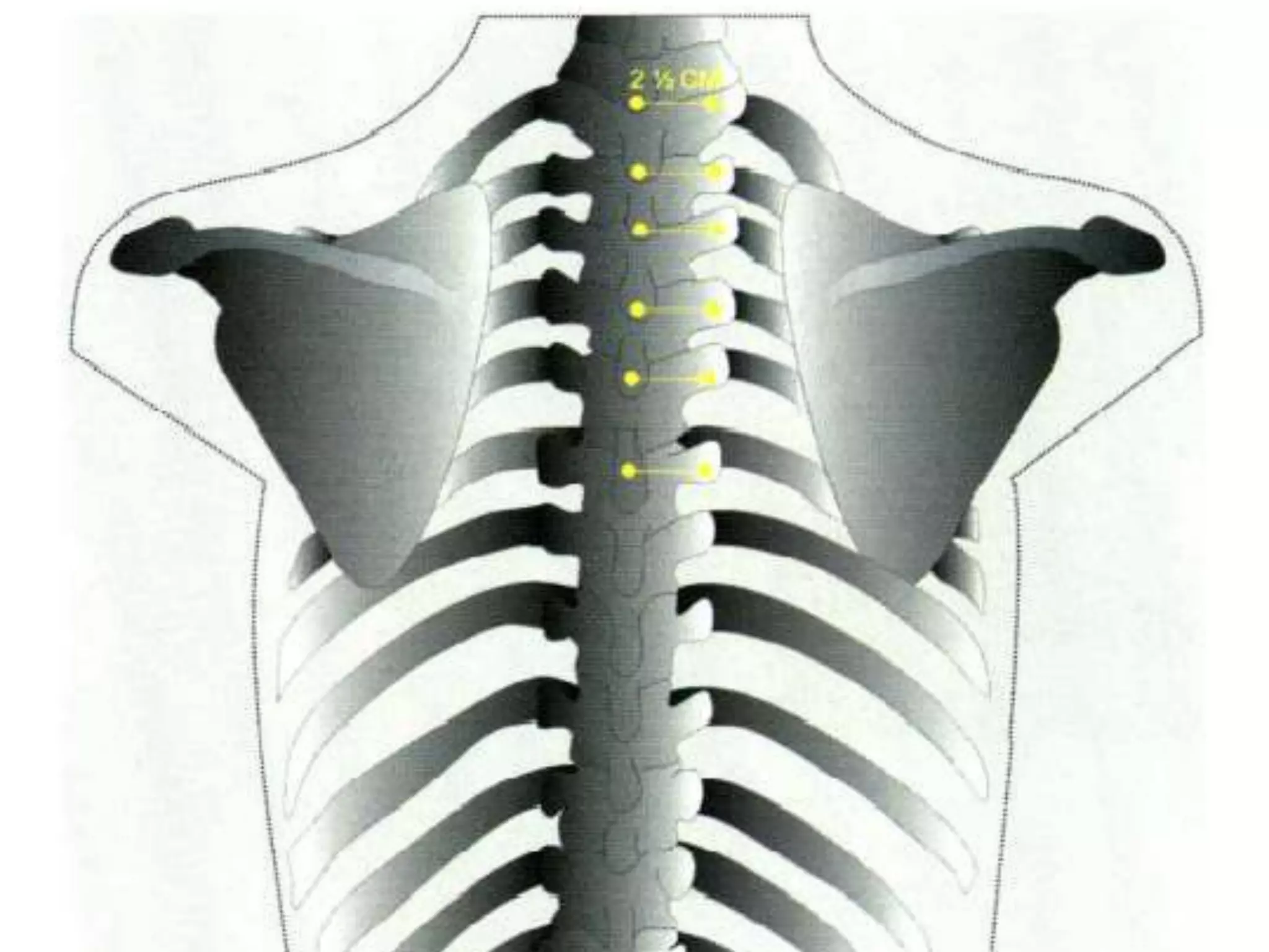 Ultrasound-Guided Thoracic Paravertebral Block | PPTX