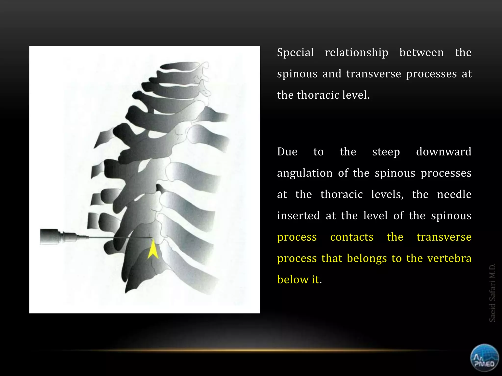 Ultrasound-Guided Thoracic Paravertebral Block | PPTX