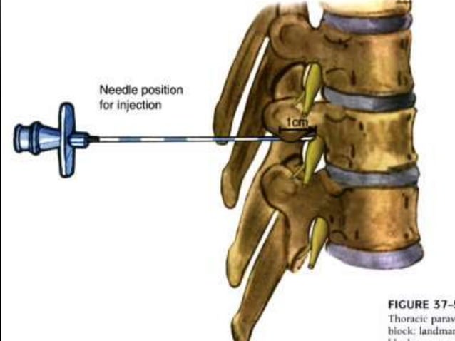 Ultrasound-Guided Thoracic Paravertebral Block | PPTX