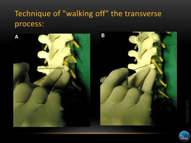 Ultrasound-Guided Thoracic Paravertebral Block | PPTX