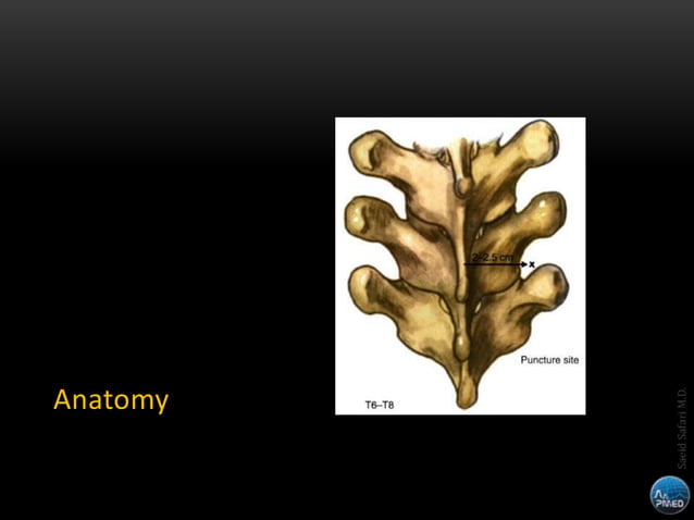 Ultrasound-Guided Thoracic Paravertebral Block | PPTX