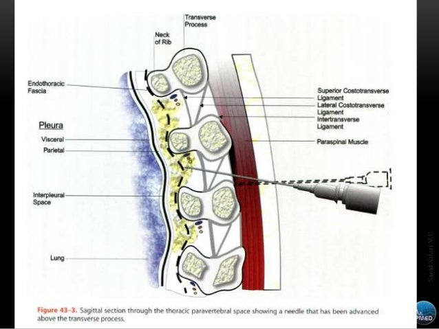 Ultrasound-Guided Thoracic Paravertebral Block