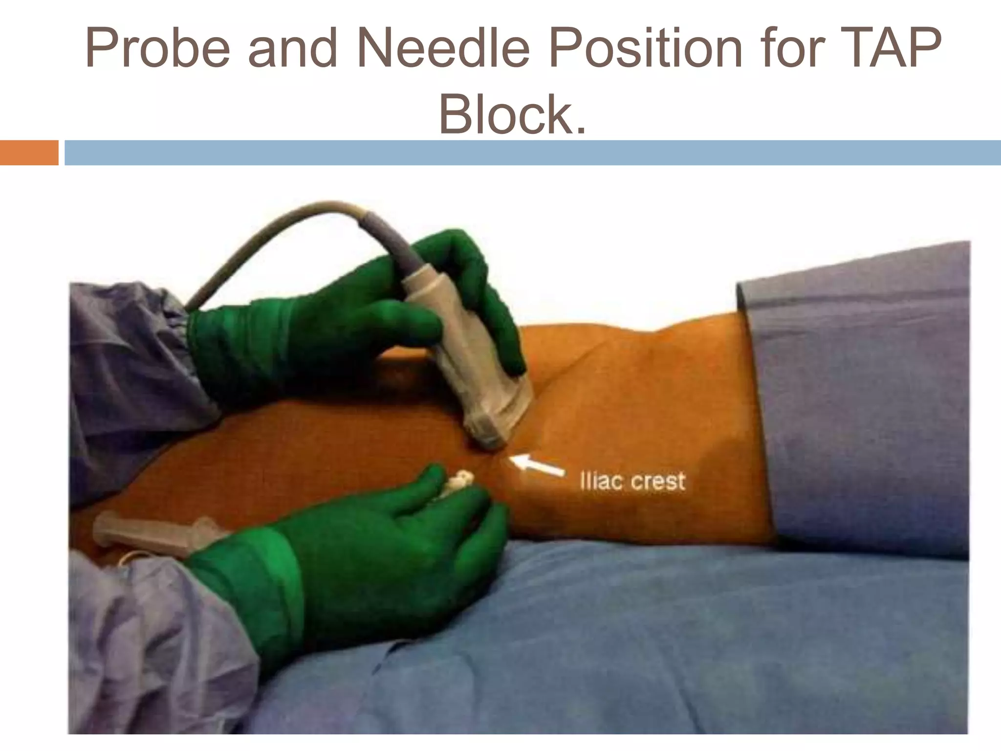 Ultrasound Guided Transversus Abdominis Plane (TAP) Block | PPTX