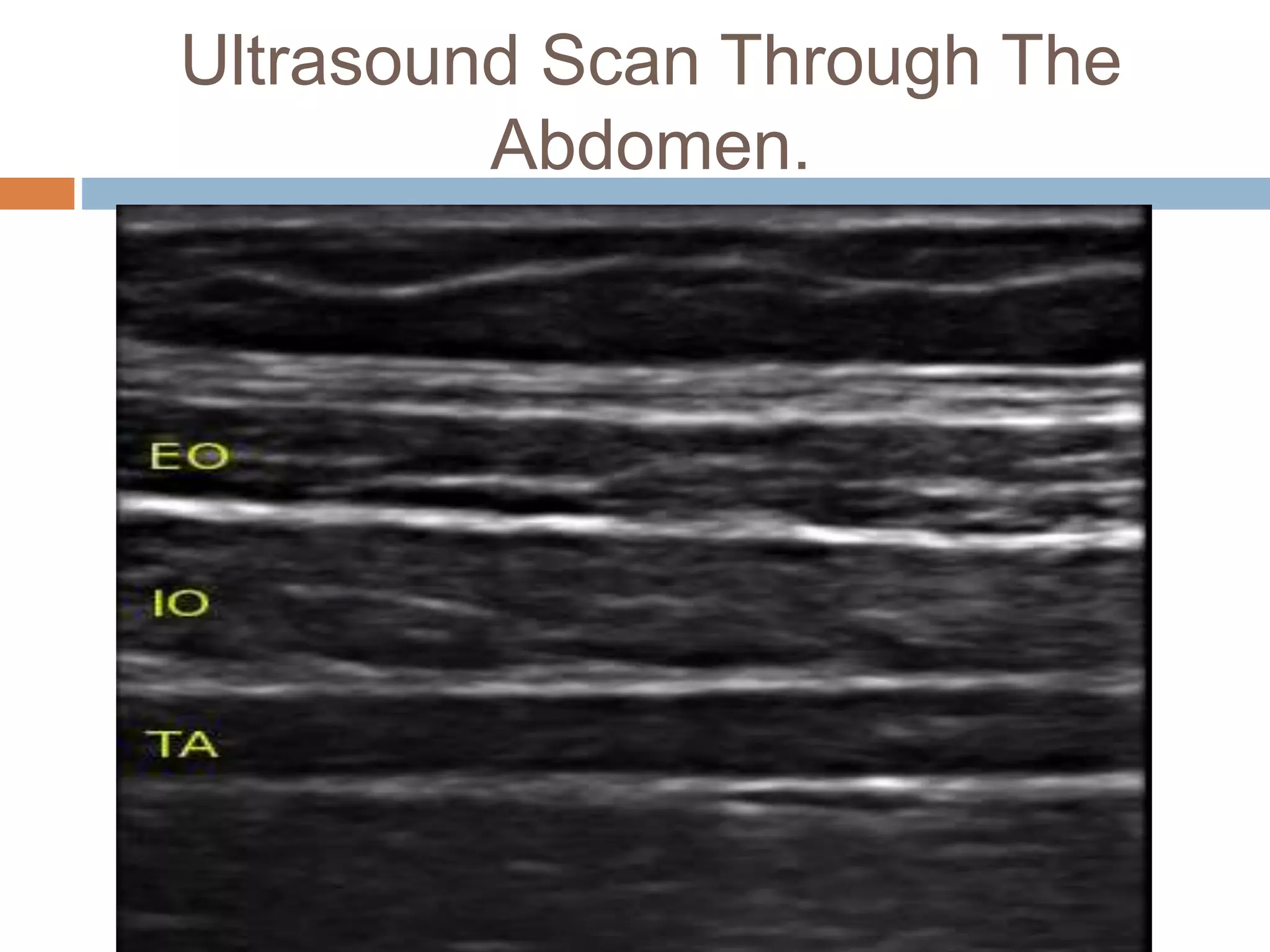Ultrasound Guided Transversus Abdominis Plane (TAP) Block | PPTX