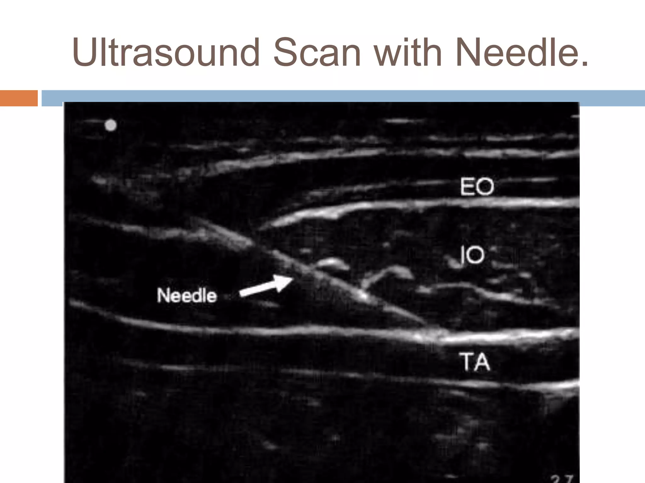 Ultrasound Guided Transversus Abdominis Plane (TAP) Block | PPTX